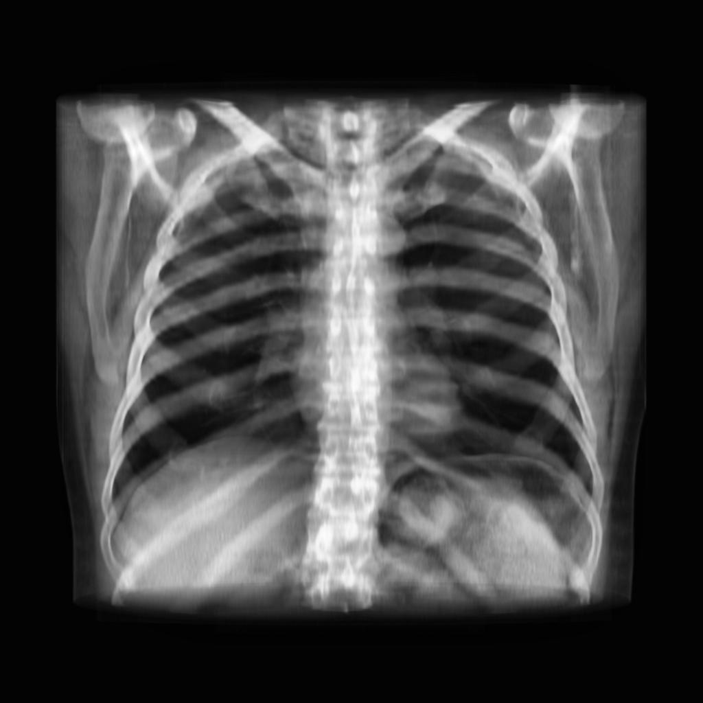 lung_detect Object Detection Model by Batuhan