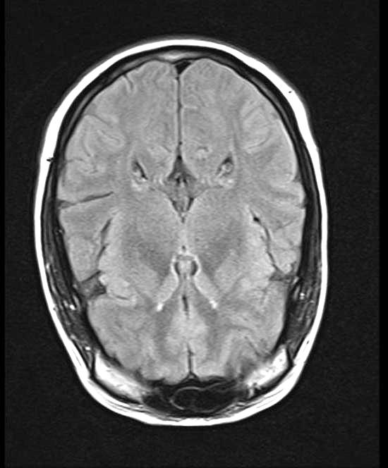 Braim Tumor Detection Roboflow Universe