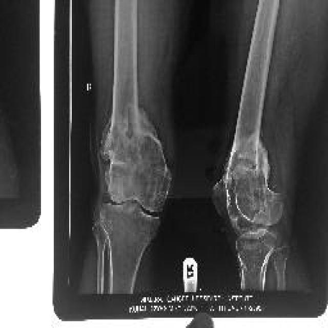 B_tumor Object Detection Model by Smart vision