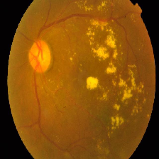 retinopathy Classification Model by classificataion