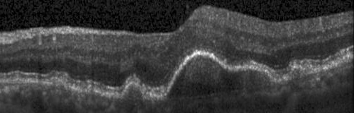 drusen Instance Segmentation Dataset by oct