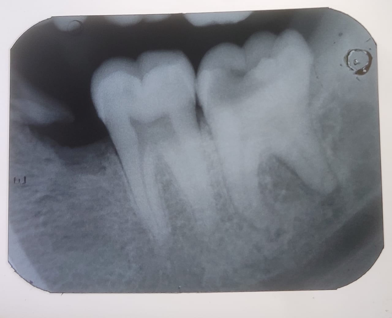 Dental Problems Object Detection Dataset And Pre Trained Model By Dental