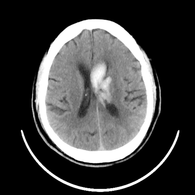 brain_hemorrhage detection and c Object Detection Dataset by Brain ...