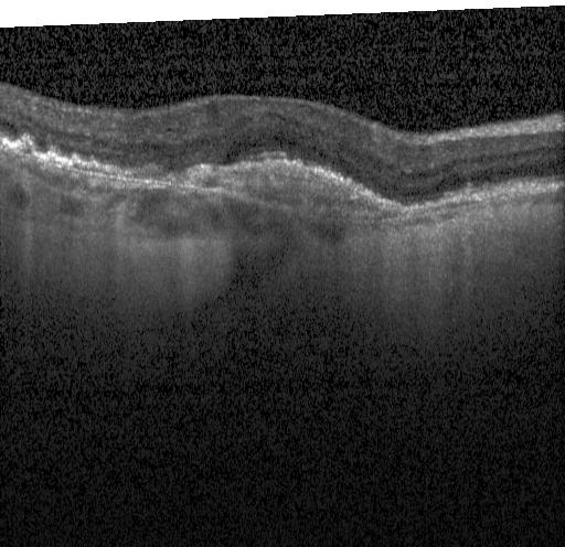 Retina-Disease Classification Dataset and Pre-Trained Model by Oms space