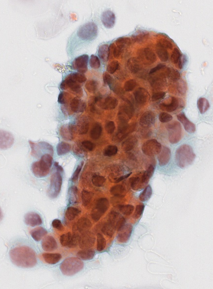 urine cell classification Classification Dataset by urine cytology