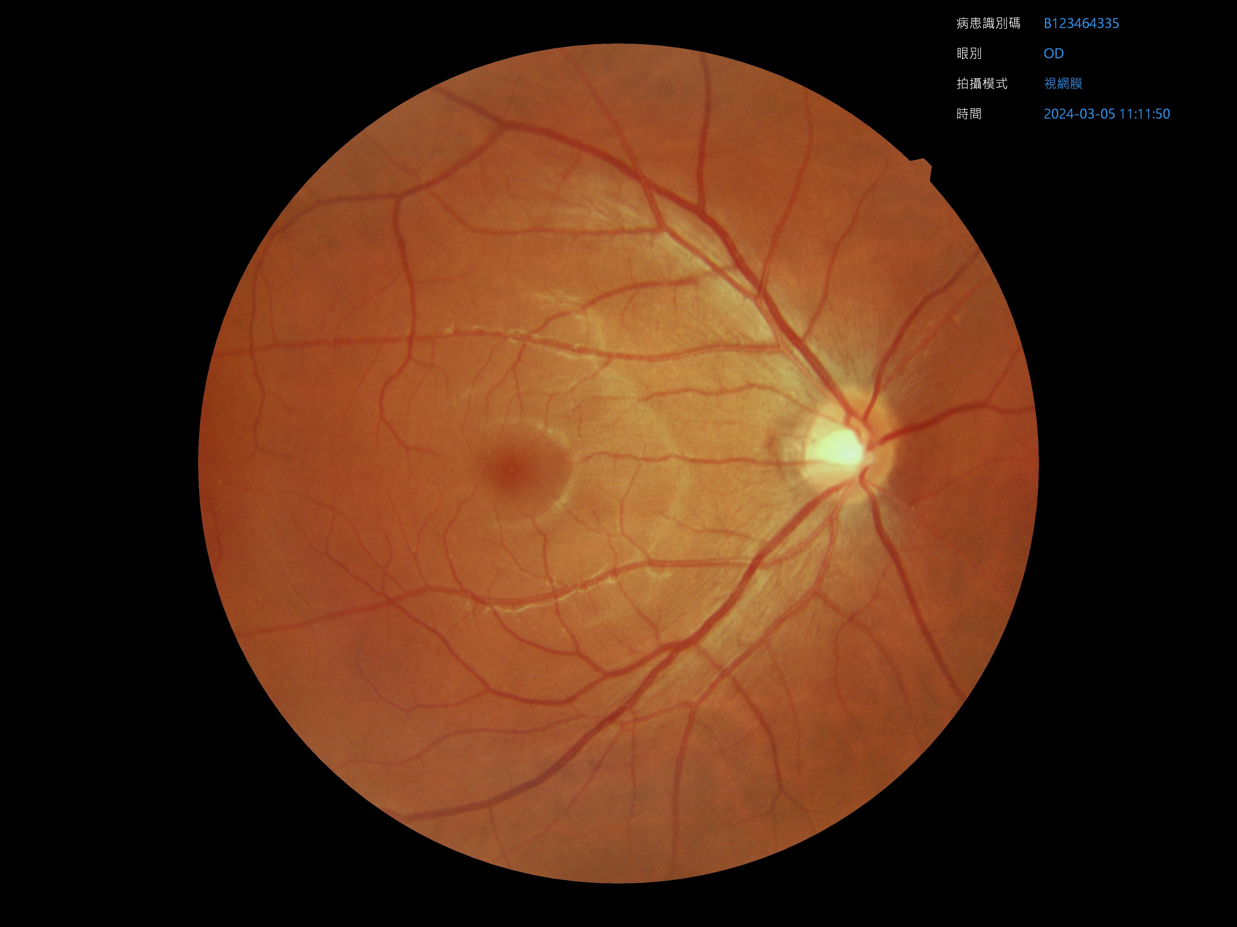 Glaucoma Classification Dataset by National Chung Cheng University