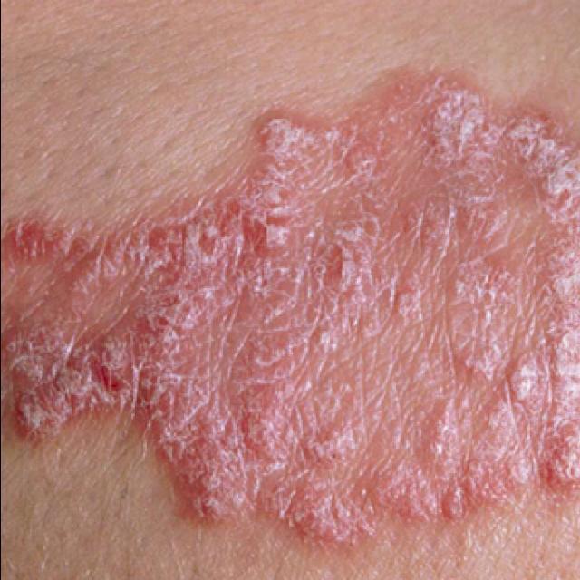 V5 Dataset 150 Object Detection Dataset By Skin Diseases