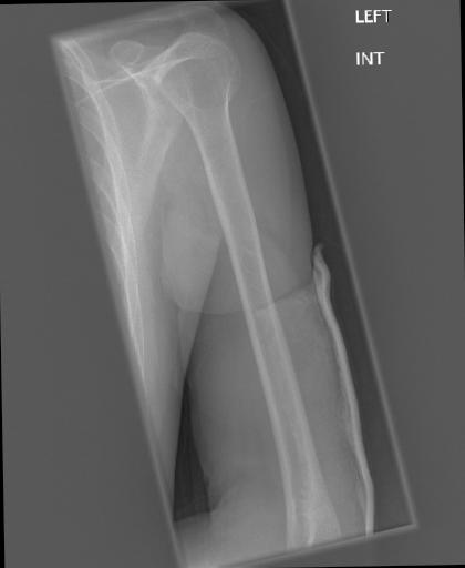 Bone Fracture Detection Object Detection Dataset And Pre Trained Model