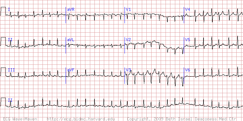 How to Use the ECG.analyze Object Detection API