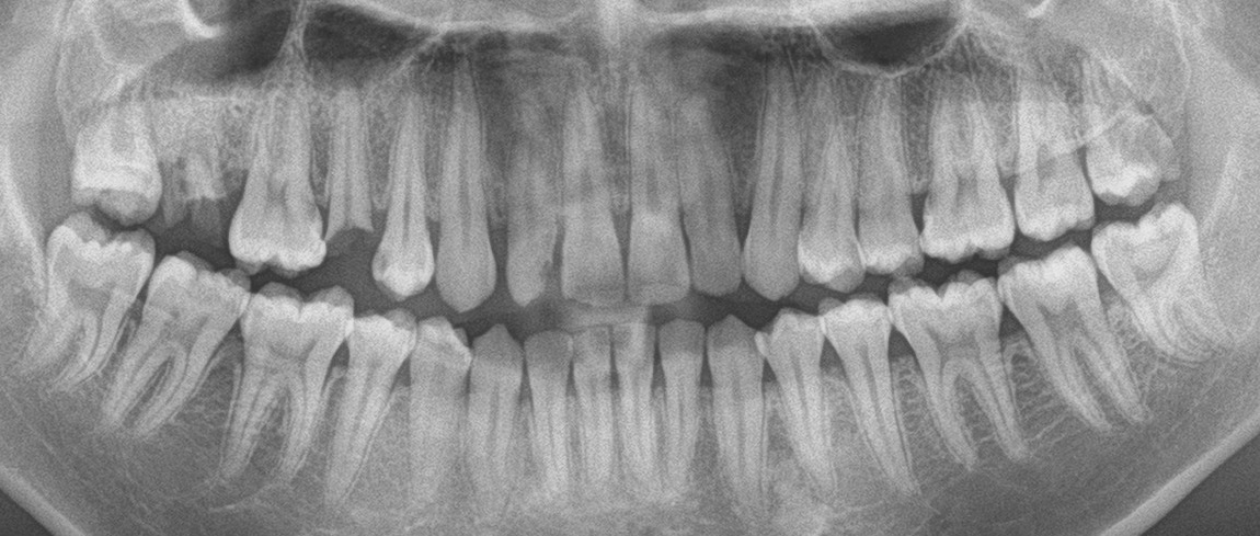 Segmentasi Caries Instance Segmentation Model by meirani