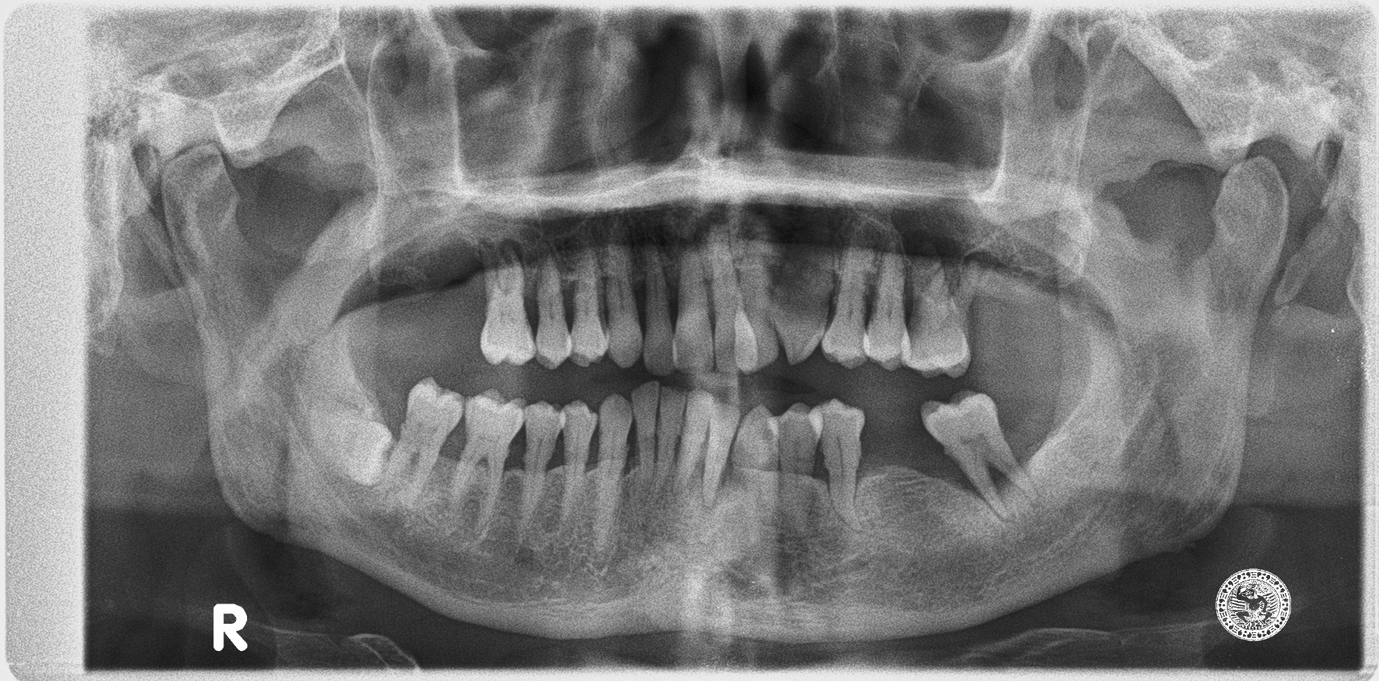 Deteksi Periodontal Bone Loss Object Detection Model By Meirani