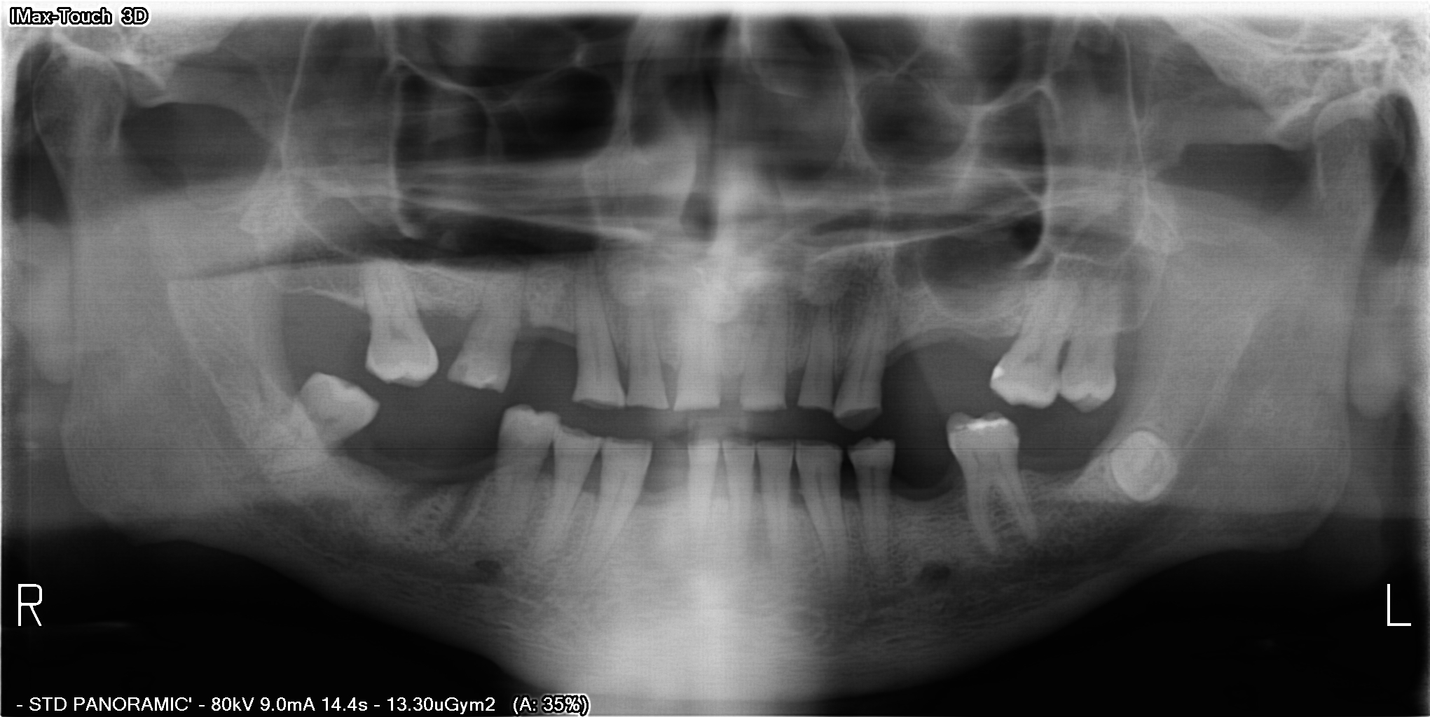 Teeth Dataset New Object Detection Dataset By Teethsegmentation