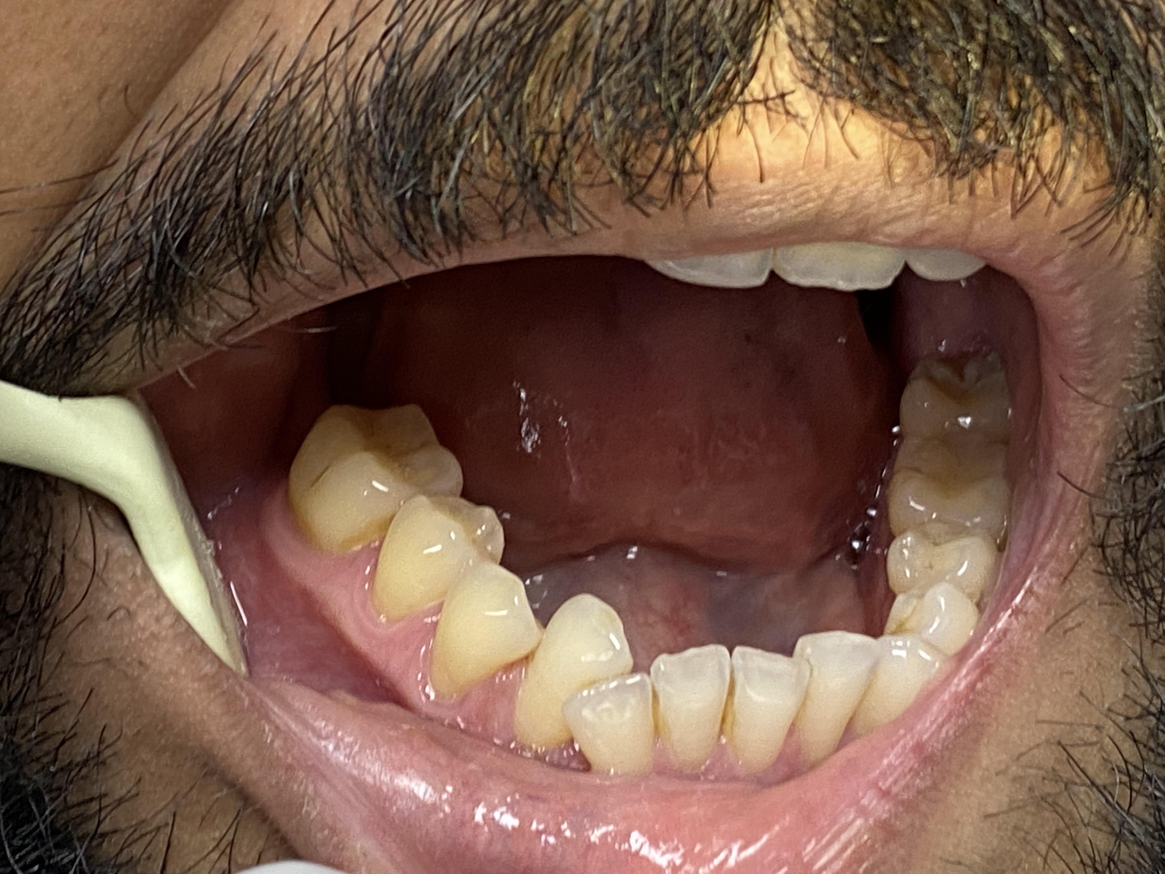 Teeth Segmentation Lower Object Detection Dataset By Teethsegmentation