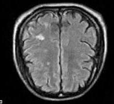 Brain Tumor Detection Object Detection Dataset by Brain Tumor Detection