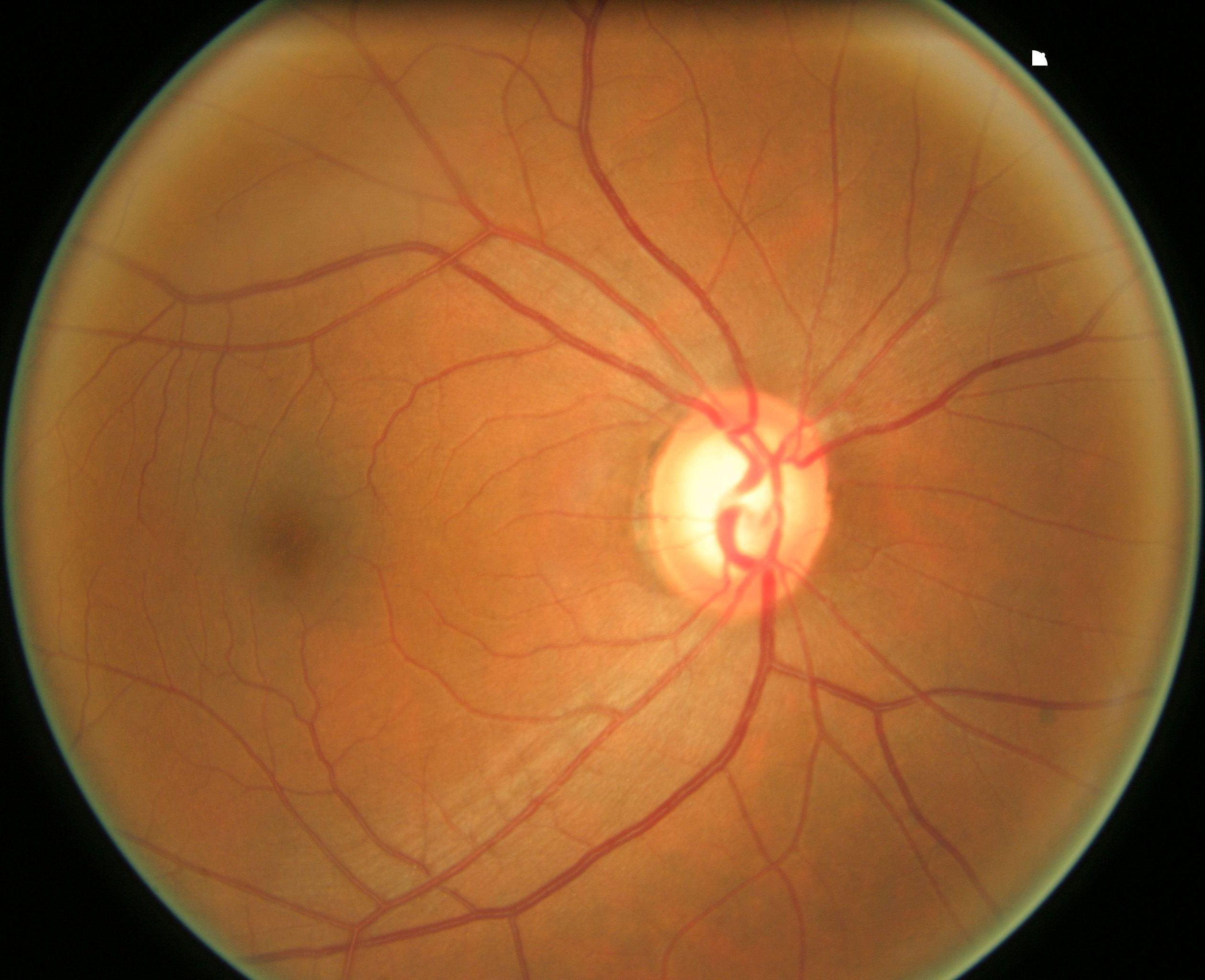 How to Use the NOTCH GLAUCOMA DETECTION Object Detection API