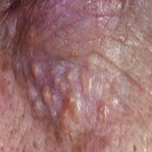 Acne Dataset Preparation Object Detection Model By Skin Types