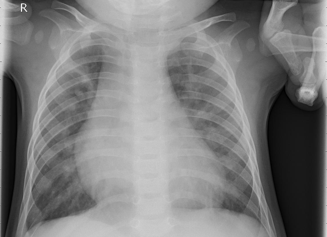 Pneumonia Project Object Detection Dataset By Fadli Dwi