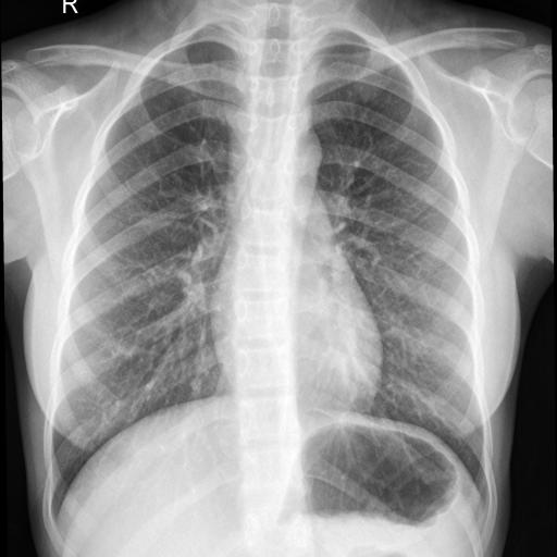 Pneumonia Project Object Detection Dataset By Fadli Dwi