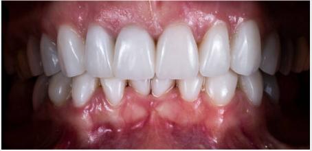 tooth disease Classification Dataset by tooth disease