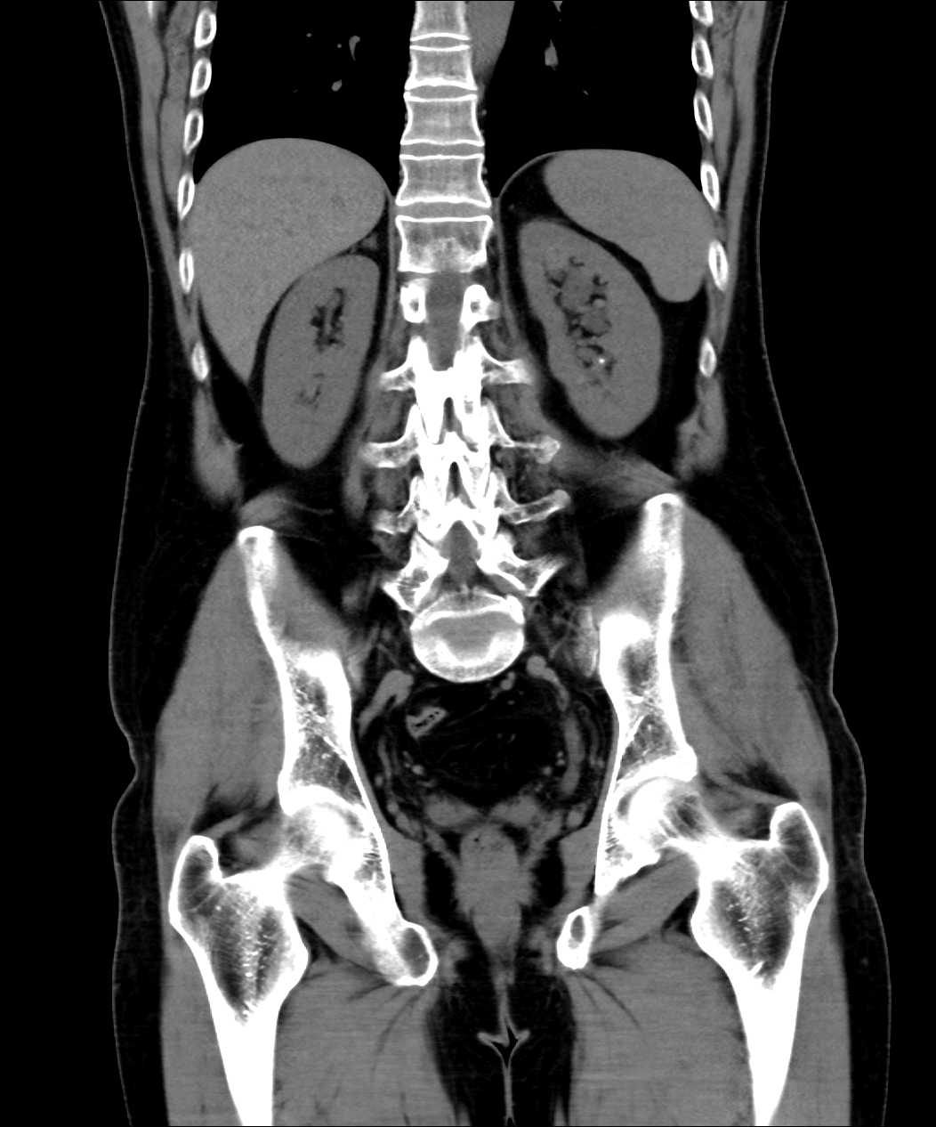 kidney-stones Instance Segmentation Dataset by abdalluh