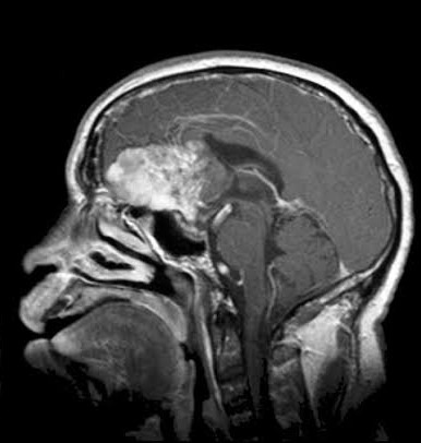 Crystal Clean: Brain Tumors MRI Dataset Object Detection Dataset by My ...