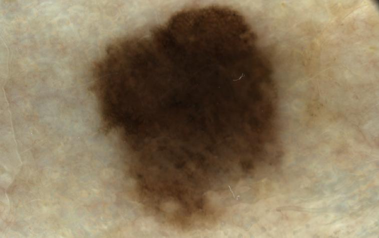 Skin Cancer AI Final Classification Dataset by Xavi