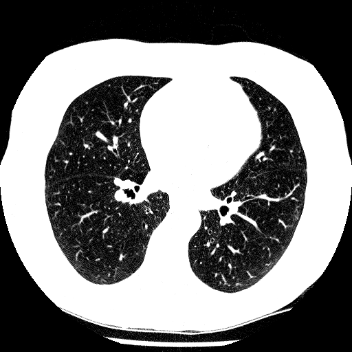 Cancer pulmonar Object Detection Dataset by UTEM
