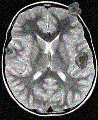 Tumor Object Detection Dataset by PFE