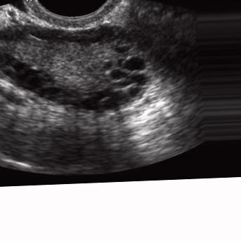 pcos_detection_using_ultrasound_ Instance Segmentation Dataset by PCOS ...