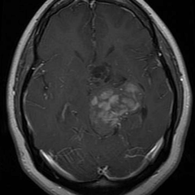 Brain Tumor Detection More Object Detection Dataset And Pre Trained