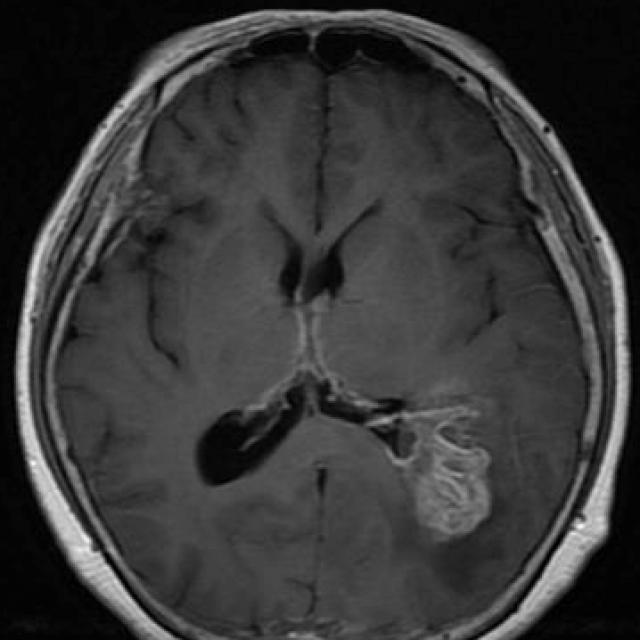Brain Tumor Seg Instance Segmentation Dataset V2 2024 06 09 900pm