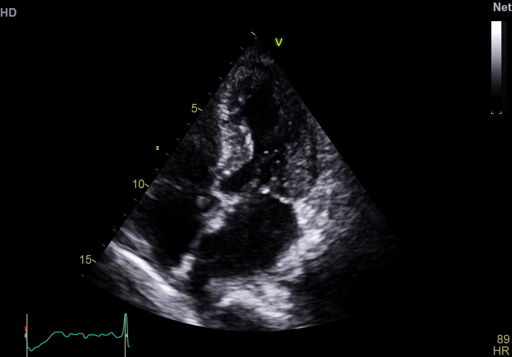heart_ai Instance Segmentation Model by chahd