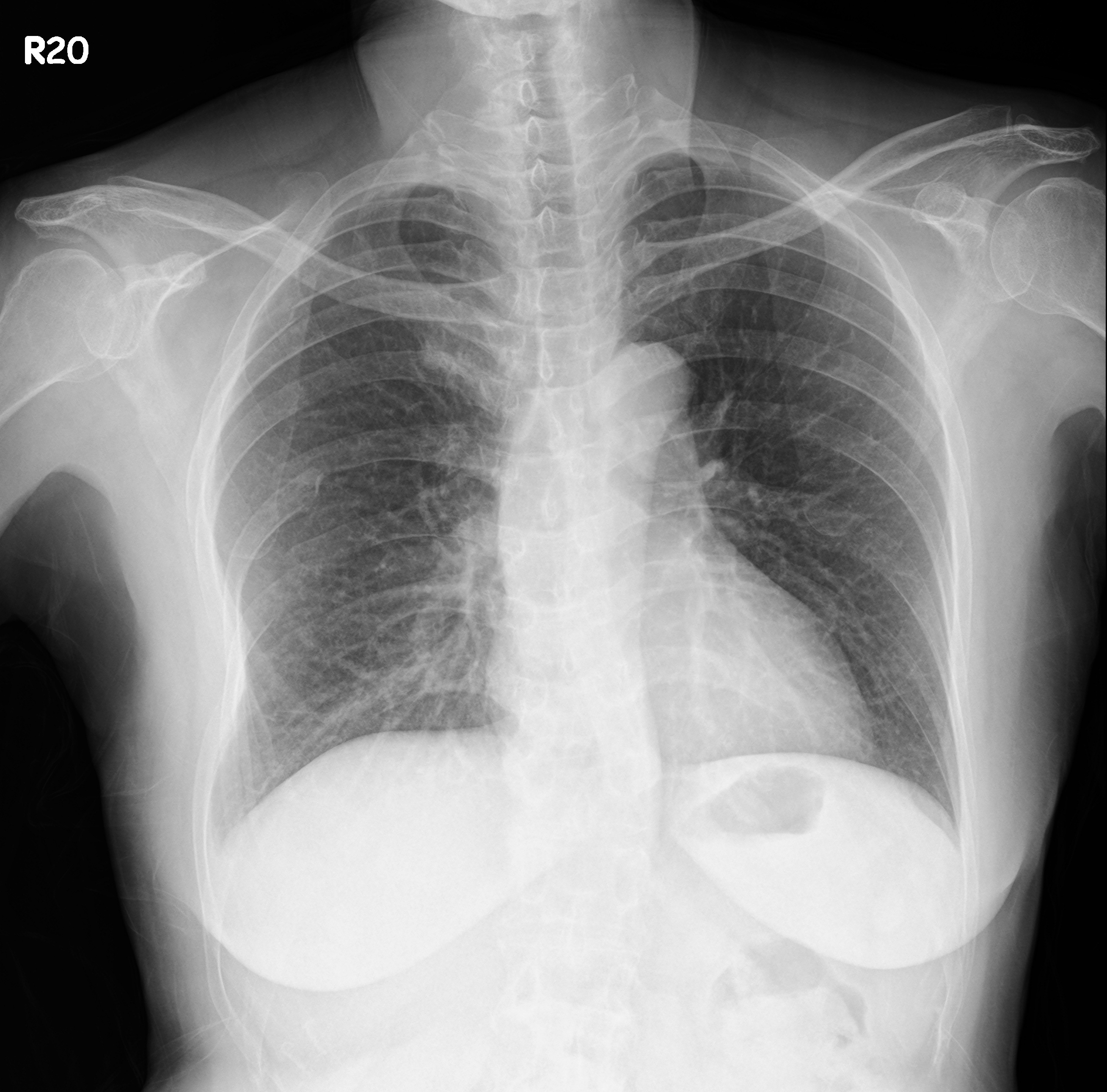 Rib Fracture Mine Object Detection Dataset By Chest Xray