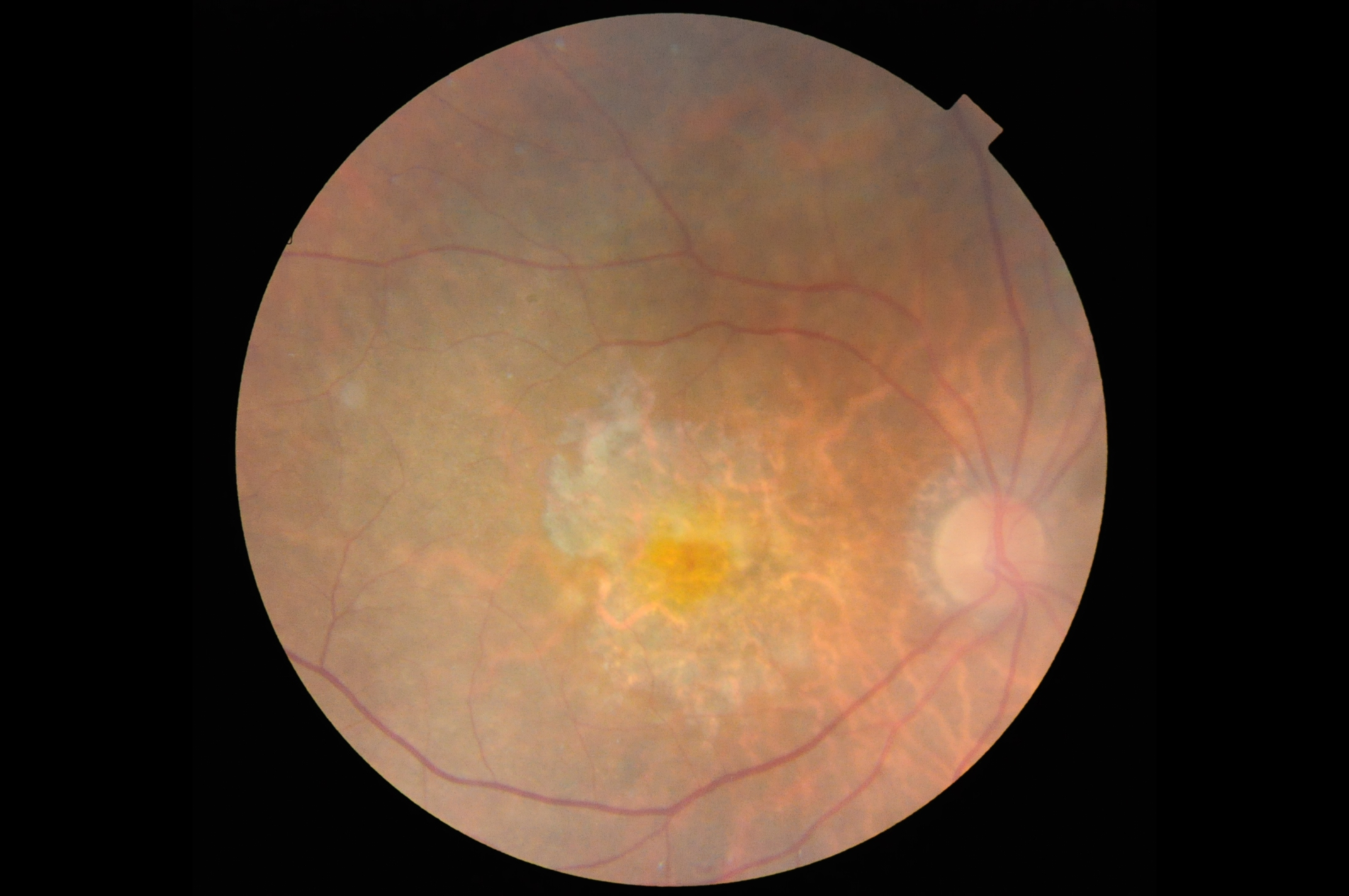 RET (ret-hclqs) - Roboflow Universe