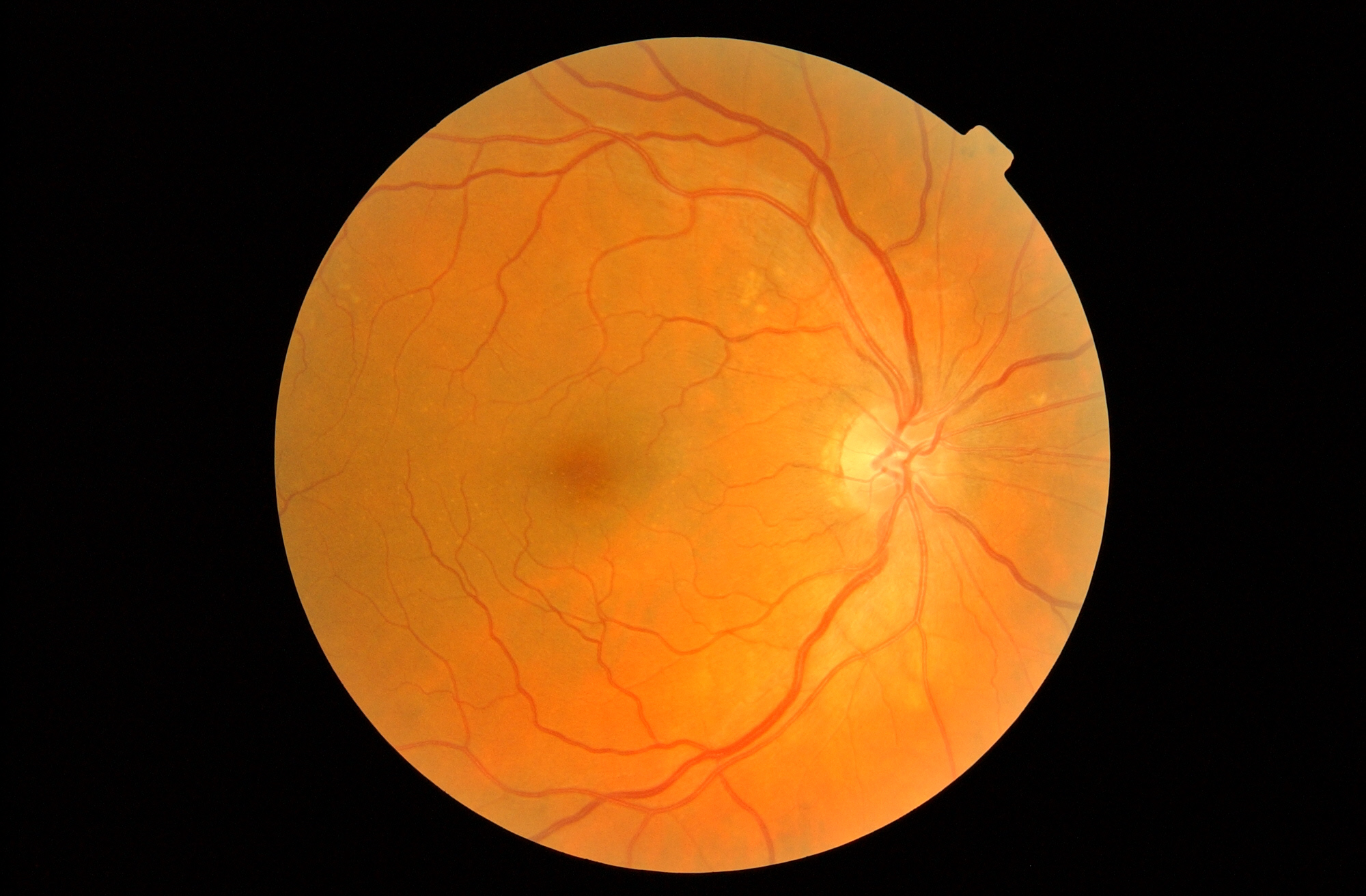 fundus-defects Object Detection Dataset by prsworkspace