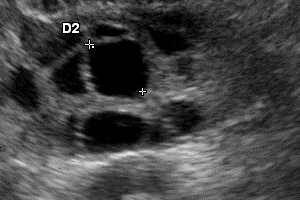 PCOS Detection Object Detection Dataset by PCOS Detection