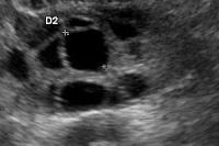 PCOS Detection (pcos-detection-ichnz) - Roboflow Universe