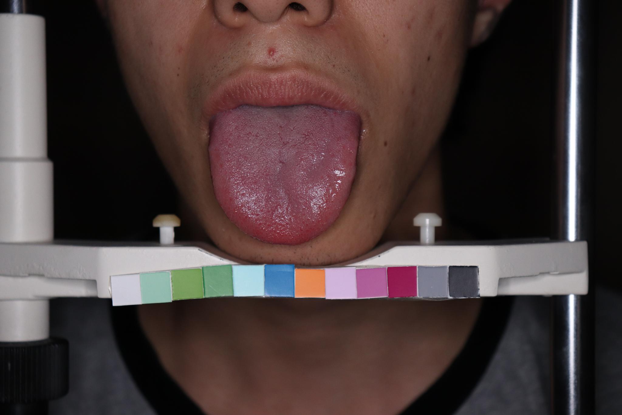 kawasaki_disease_tongue Object Detection Model by eric