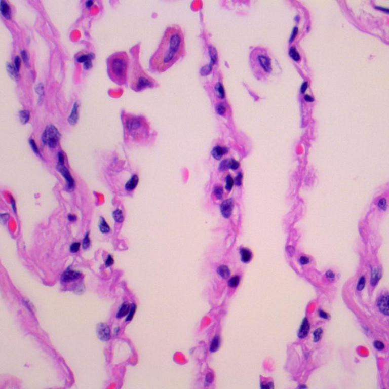 Count Lung Cancer Object Detection Dataset By Sukit
