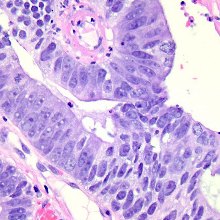 count colon cancer Object Detection Dataset by sukit