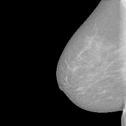 breast_cancer Object Detection Model by robots