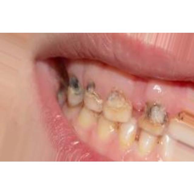 caries_crowded_calculus Object Detection Dataset by GigiKita