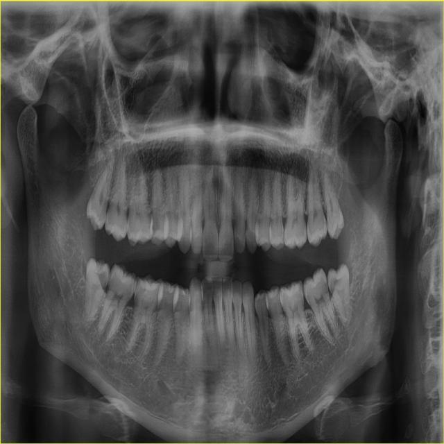 Dental Disease Instance Segmentation Dataset and Pre-Trained Model by yugant