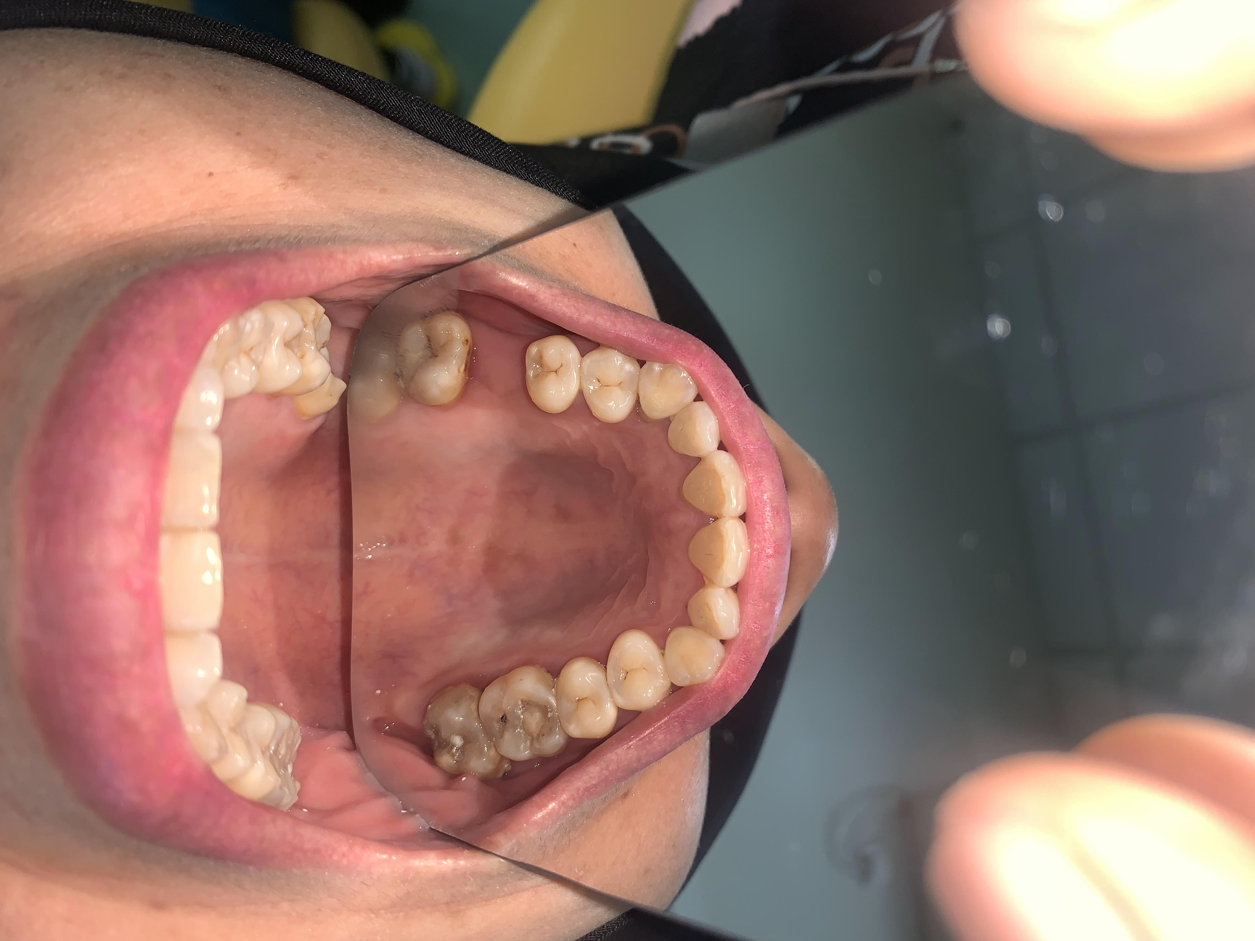 Caries Object Detection Dataset And Pre Trained Model By Yasmina Elma