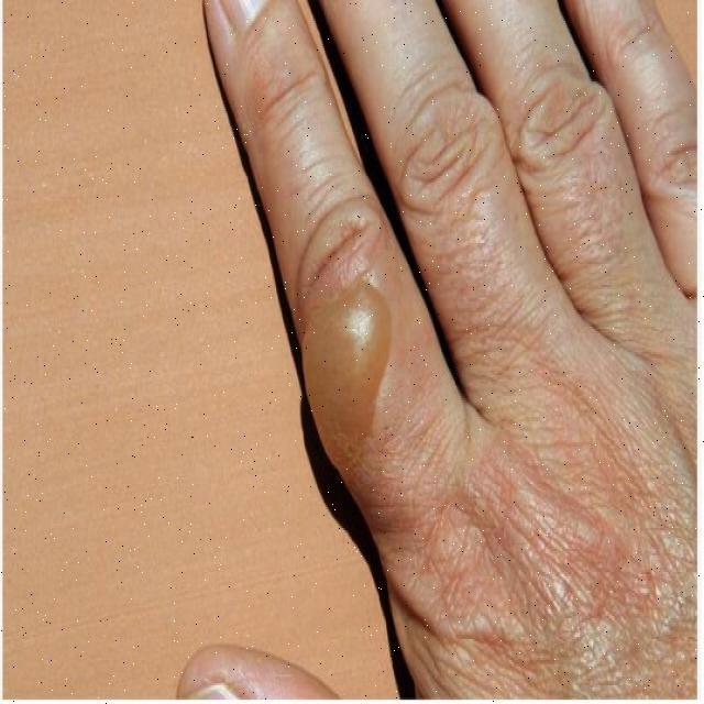 NCKU IDBA Burns Segmentation - Roboflow Universe