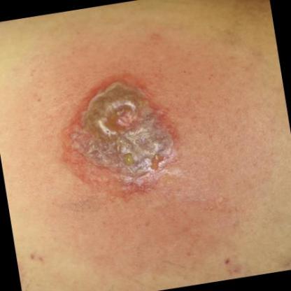 4-Pustules(5-7 days) Classification Dataset by Digital Twin