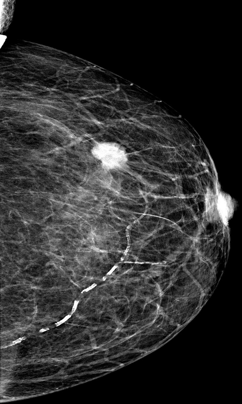 Kangker Payudara Object Detection Dataset and Pre-Trained Model by pcd