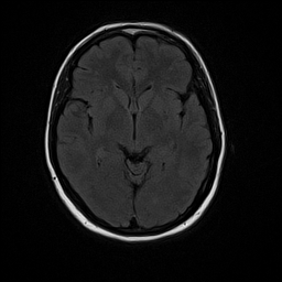 MRI_Brain Instance Segmentation Dataset by Home