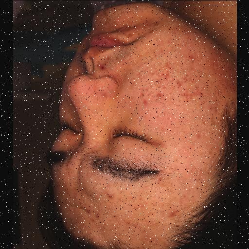 acne Object Detection Model by project