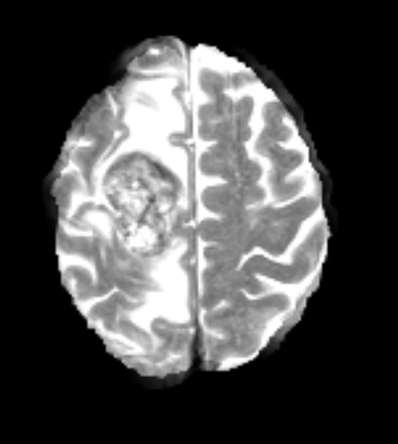 Brain Tumor Mri Instance Segmentation Dataset And Pre Trained Model By Brain Tumor Mri